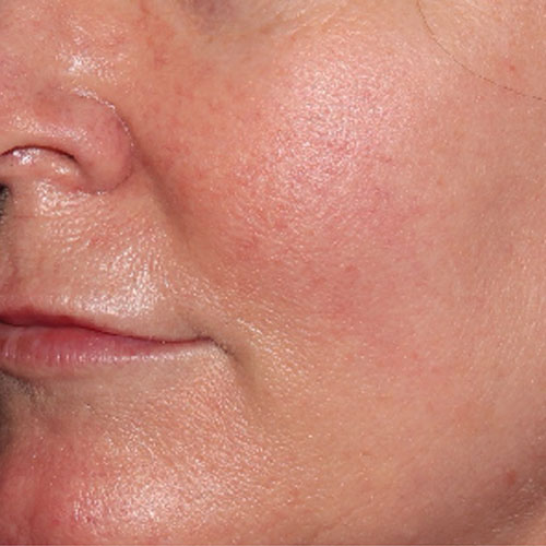 Forever Young BBL™ Treatment in Gainesville, Florida